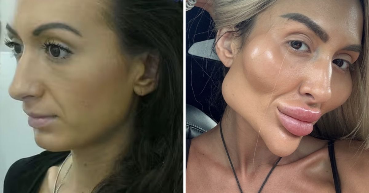 Woman With 'World's Biggest Cheeks' Shares Photo Of What She Looked ...